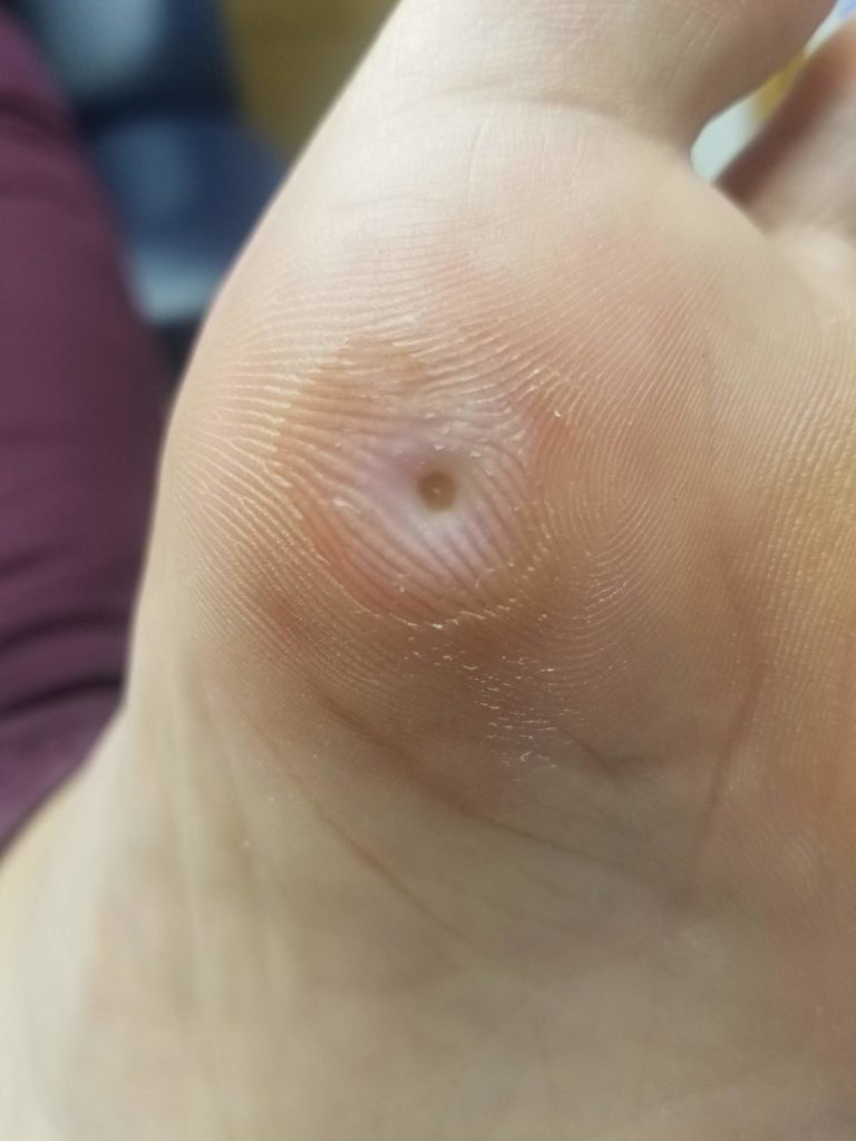 National Feet Week - 10 painful foot conditions that can be cured ...